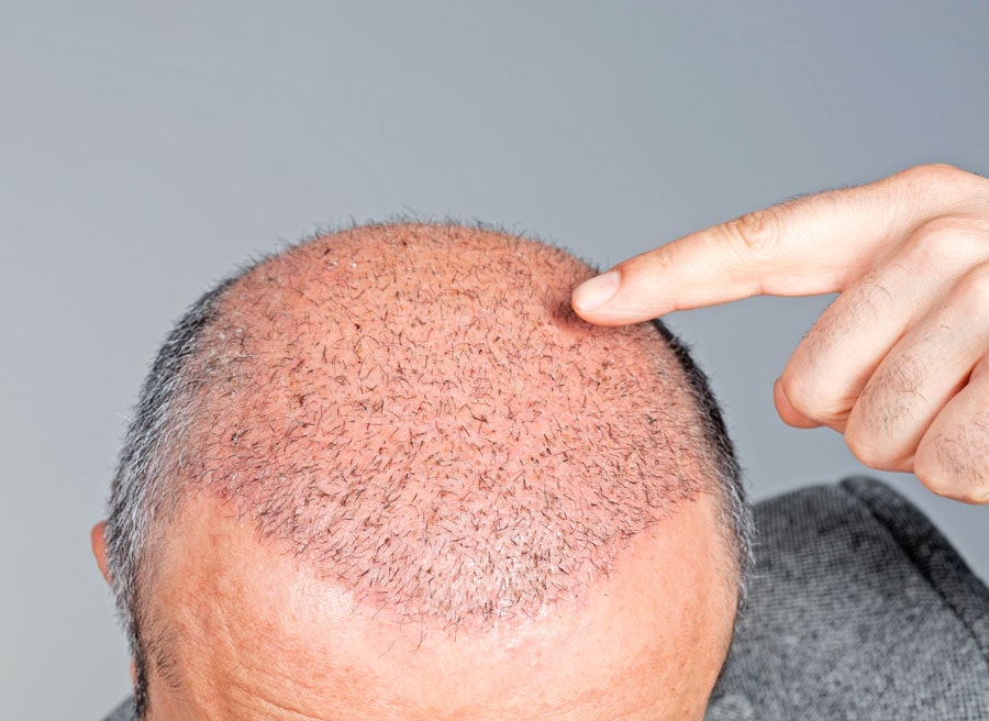 Trapianto dei capelli - Trapianto di capelli in Albania