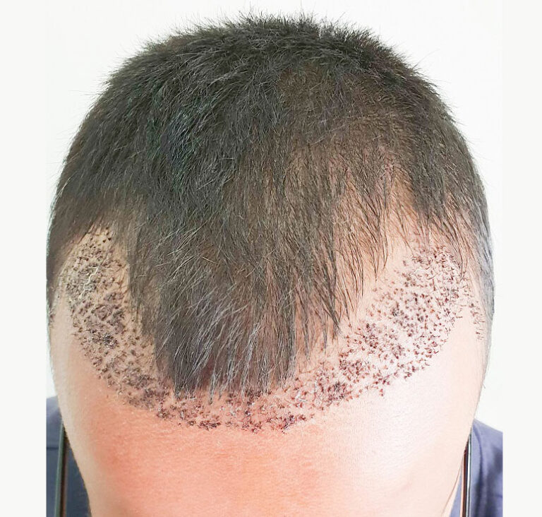 Trapianto dei capelli - Trapianto di capelli in Albania